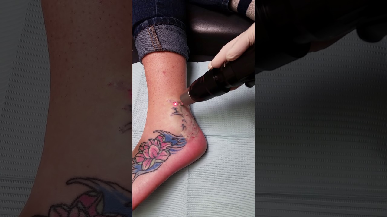Schweiger Dermatology Group's Dr. Jeremy Fenton performs a tattoo removal