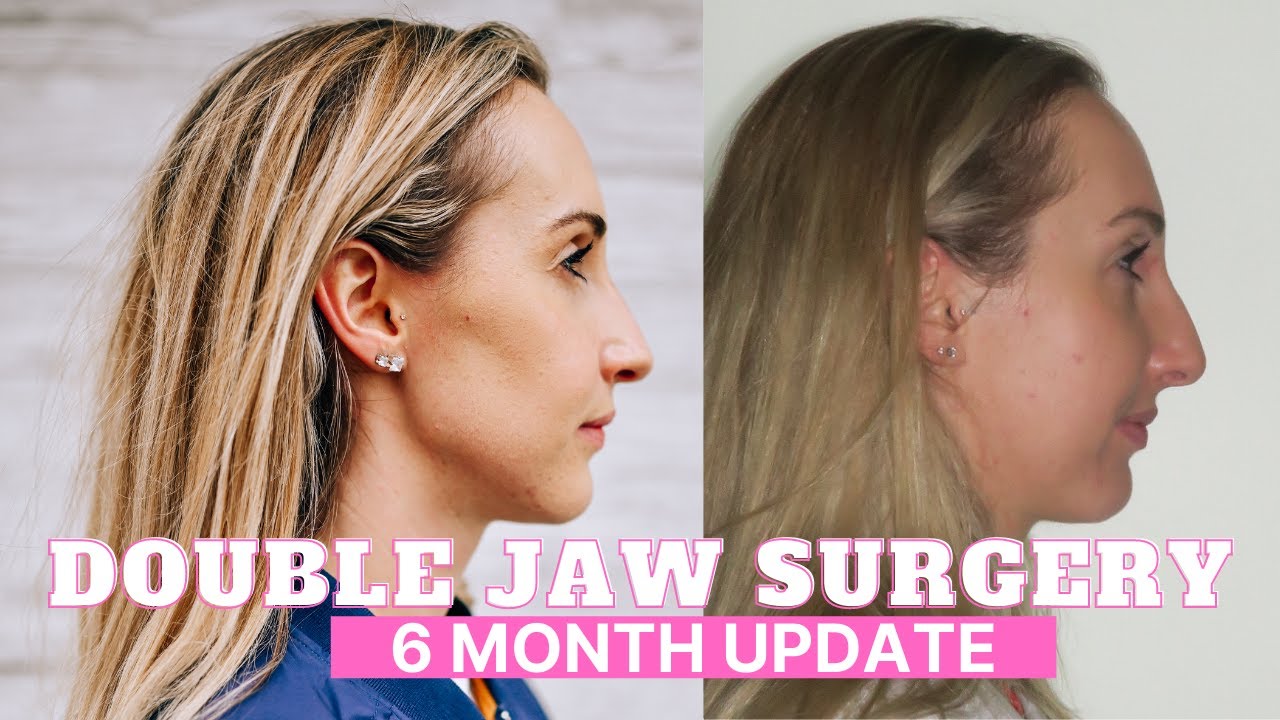 Double Jaw Surgery 6 Months Post-Surgery Update