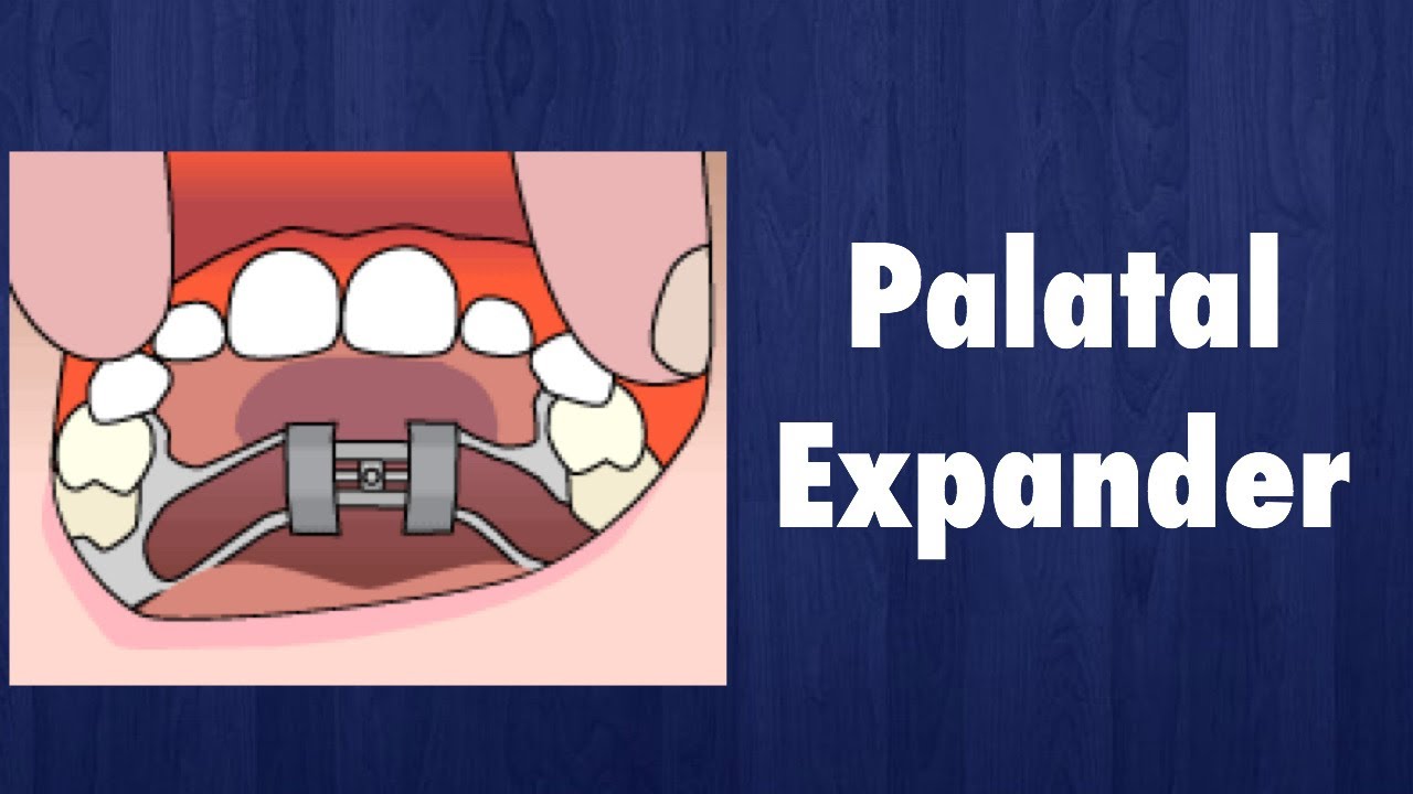 Palatal Expander - Lasley Orthodontics