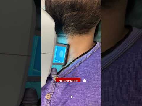 Revive Your Skin! 😍 Excimer Laser for Vitiligo 🎯 | Treat White Patches | Skinaa Clinic #shorts