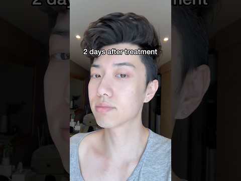 Rejuran treatment before and after #rejuran #skincare