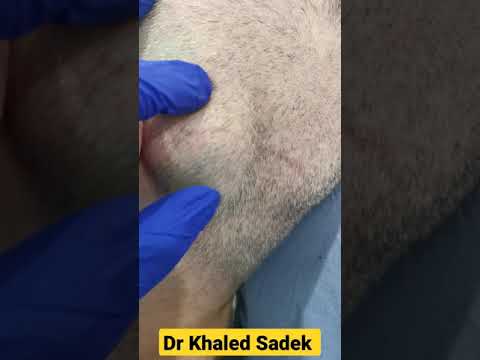 cyst or lipoma? #shorts dr khaled sadek