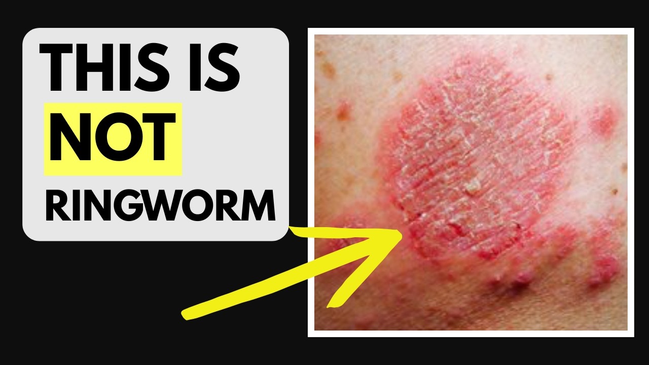 Coin-Shaped Rash? It Could Be Discoid Eczema | Causes, Symptoms & Treatment