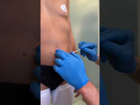 How to Tell If You Have a Hernia