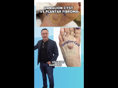 ✨ Ganglion Cyst vs. Plantar Fibroma: What's the Difference? 👣