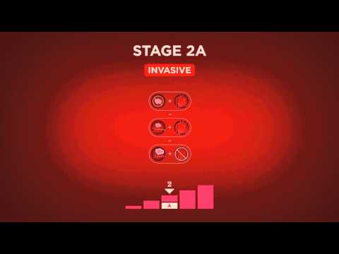 Stage 2 (II) Breast Cancer: Stages, Symptoms, Treatments and Survival Rate