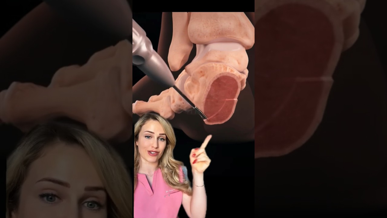 Doctor explains flatfoot surgery animation