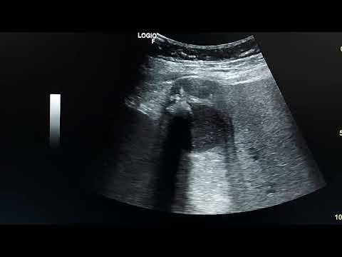 Gallbladder cancer ultrasound