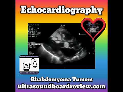 Rhabdomyoma Cardiac Tumors