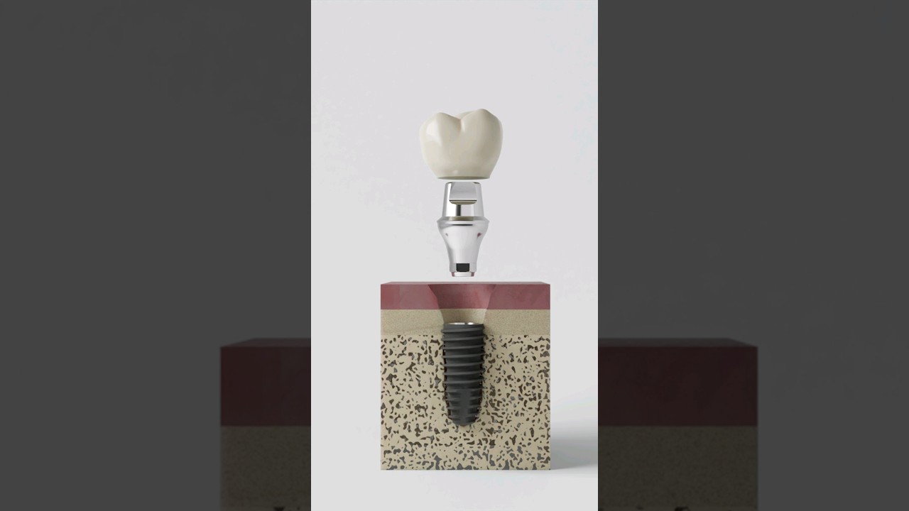 How dental implants can restore your tooth (3d animation)