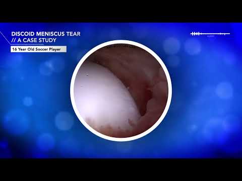 Discoid Meniscus Injury: A Case Example