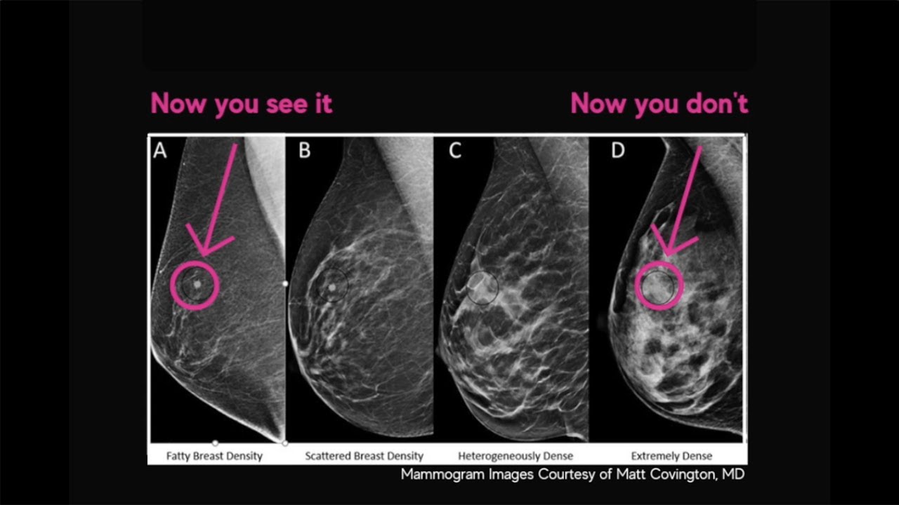 Check Your Chart - Find Out My Breast Density Day 2023