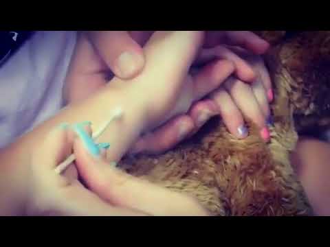 Wart Removal Done Quickly with No Pain
