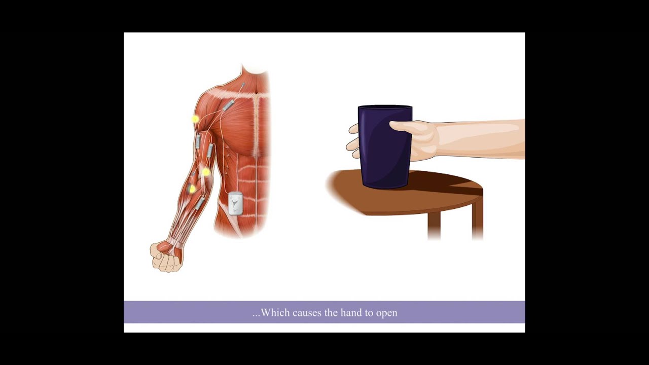Basic FES Hand Grasp for a Cervical Level Spinal Cord Injury