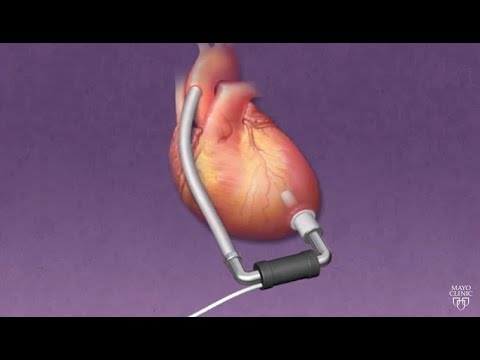 Mayo Clinic Minute: How ventricular assist devices can help heart patients