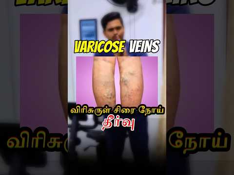 Varicose Vein Treatment in tamil #firstcarephysio #varicoseveinstreatment #healthtips