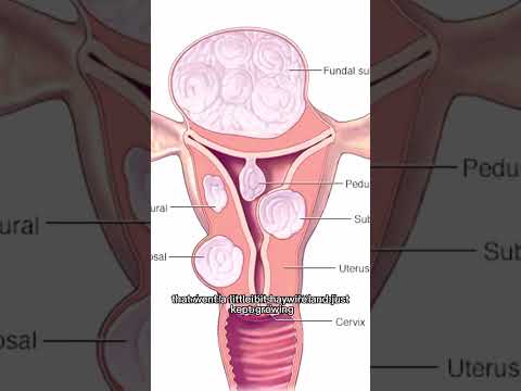 Uterine Polyp vs Fibroids