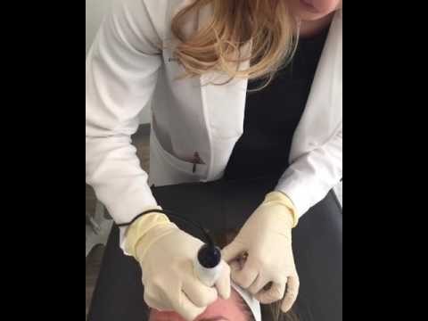 Schweiger Dermatology Group's Danielle Daughtridge performs Microneedling