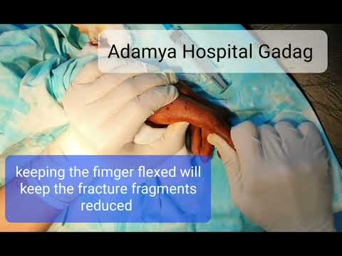 Closed reduction fracture | Proximal phalanx base index finger | Under local Anaesthesia | Adamya HV