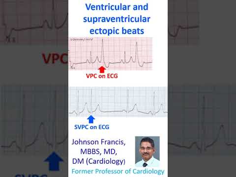Ventricular and supraventricular ectopic beats