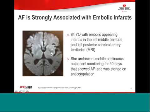 SWA Stroke Bootcamp Cryptogenic Stroke 20180816 1649 1