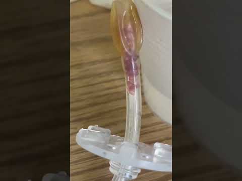 Clogged Gastrostomy Tube