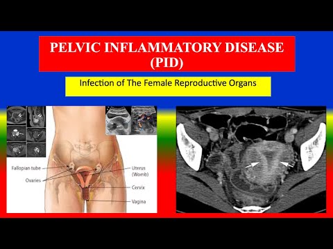 PELVIC INFLAMMATORY DISEASE (PID) - Definition, types , cusses , risk factors , signs treatment
