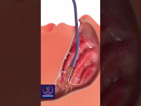 Nasal Turbinate Surgery #shorts