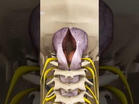 Chiari Decompression Surgery