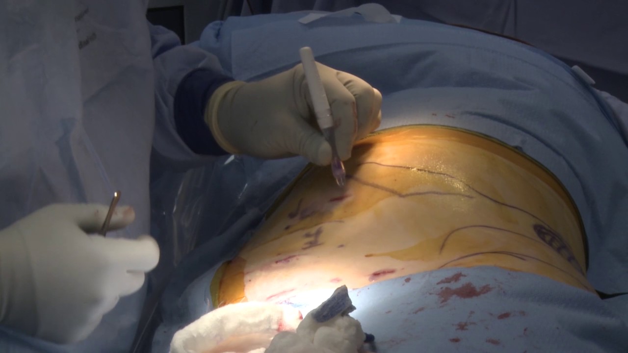 What Is A Lumbar Hernia EN General What Is A Lumbar Hernia EN General
