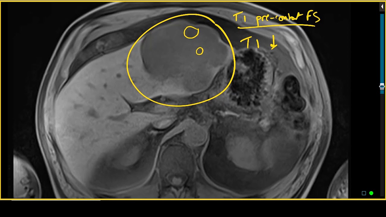 Giant Liver Hemangioma With Cystic Degeneration on MRI