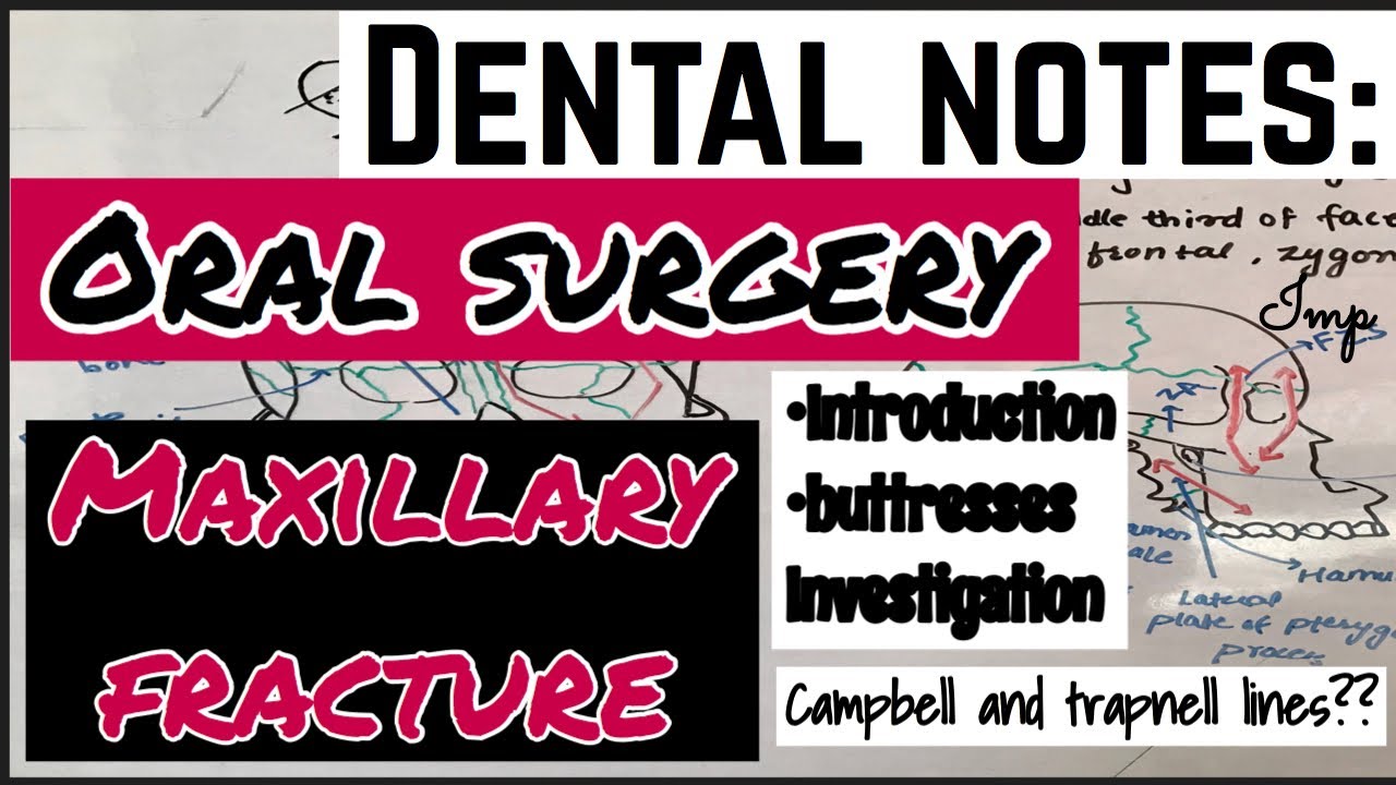 MAXILLARY FRACTURE || ORAL SURGERY || DENTISTRY LECTURE || imp