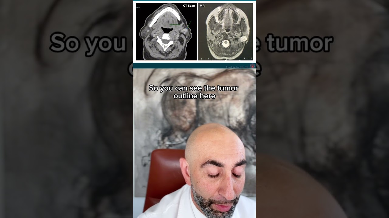 CT scan vs. MRI for parotid tumors #parotidtumor #parotidgland #parotid