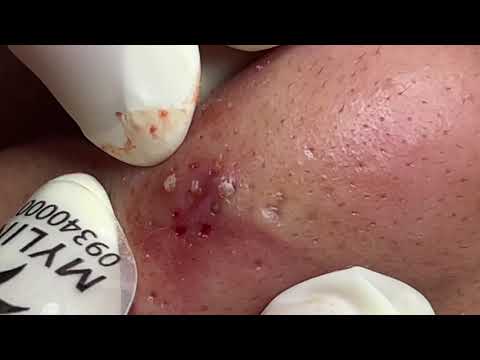 Very Rare Blackheads Flower Pattern 😅 - Linh My Dang
