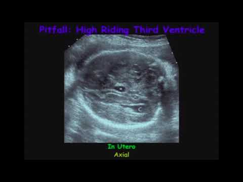 The Cavum Septi Pellucidi in Utero/ very important/ fetal usg