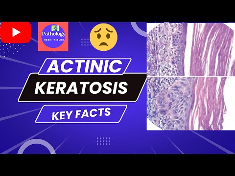 Actinic Keratosis(#shorts)|Is actinic keratosis a cancer? Key facts-usmle, neetpg, plab, fmge