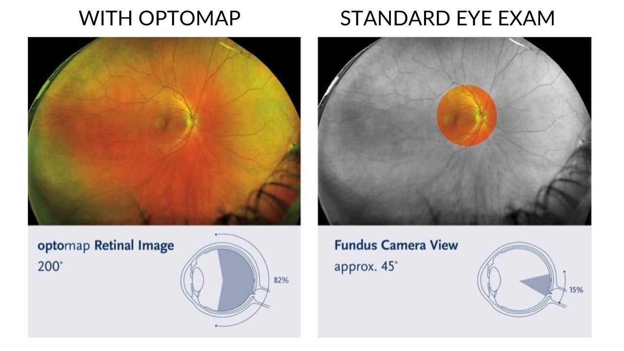 Optomap Ultra-Widefield Imaging