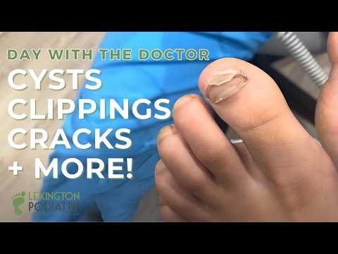 Cysts, Clippings, Cracks and More!