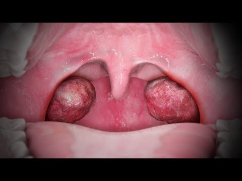 What Is Tonsillitis? Treatment