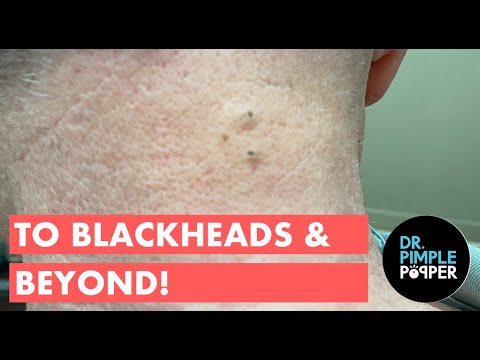 Dr. Pimple Popper Pops Juicy Blackhead Cluster In New Youtube Video