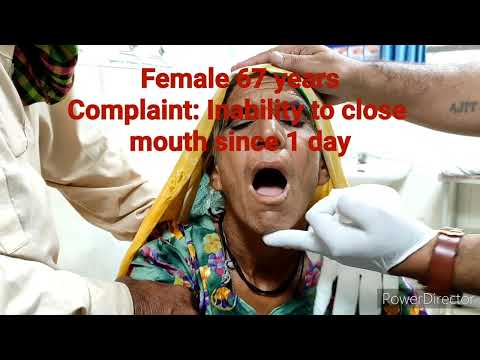 Dislocation of TMJ | Manual reduction