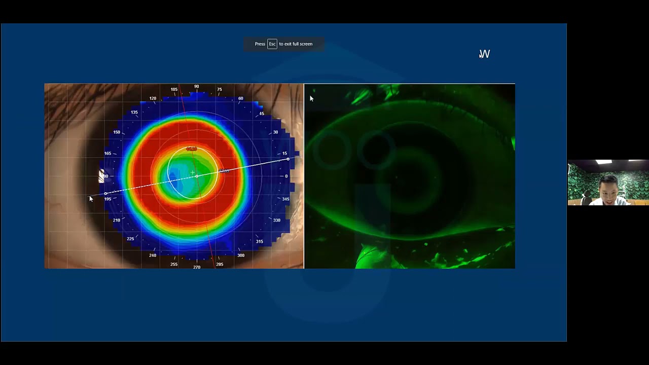 Orthokeratology 101
