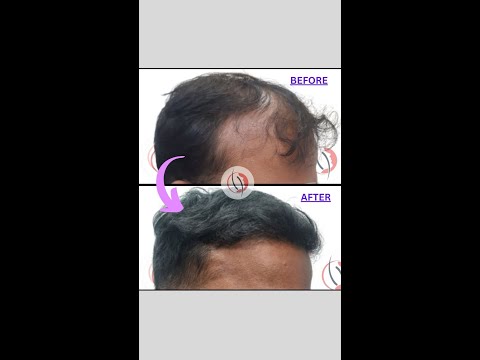 From Hair Loss to Hair Boss! šāāļøāØ