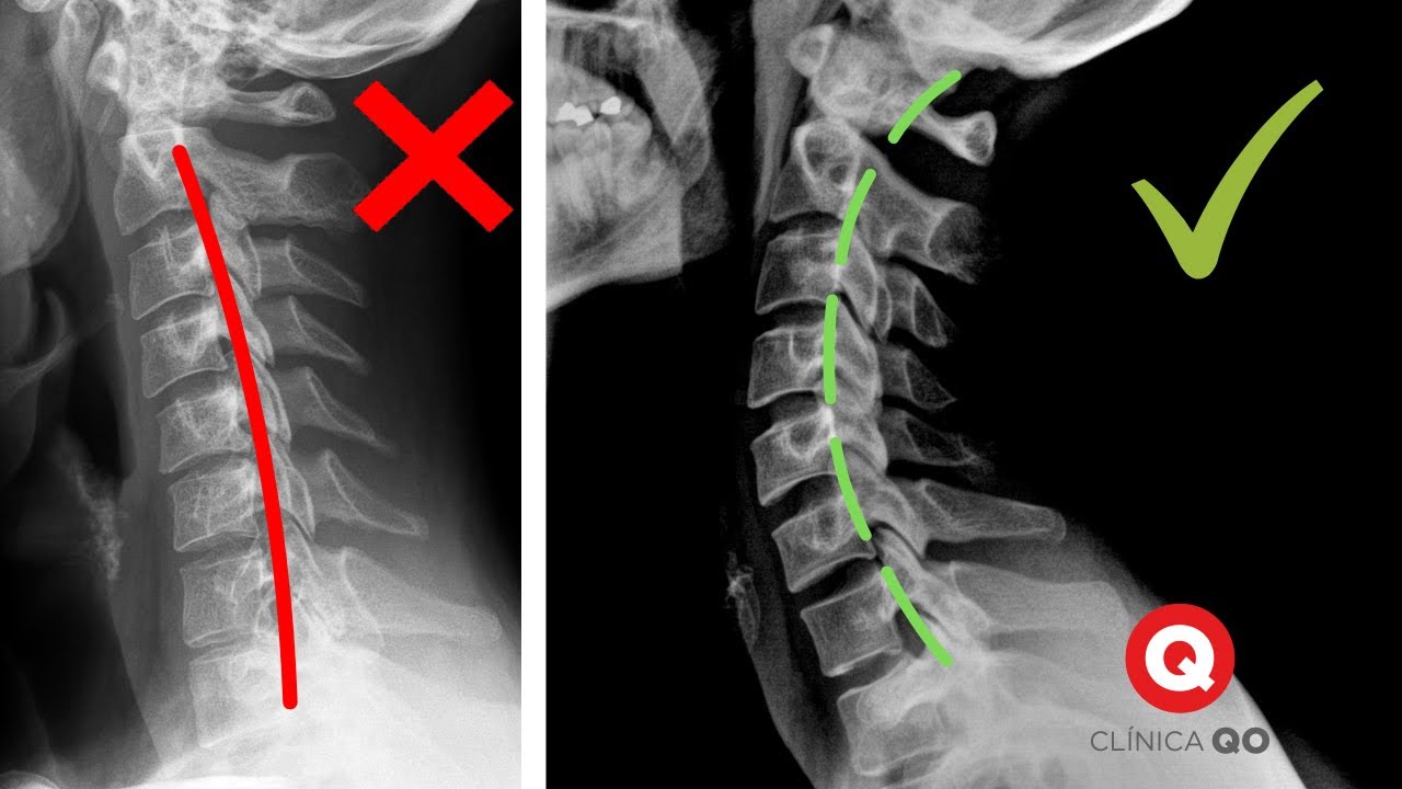 Cervical Rectification: What is it? Exercises and Tips