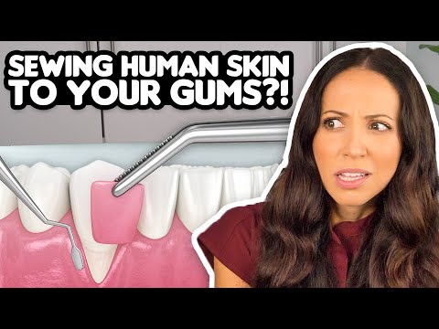 Gum Grafts Explained