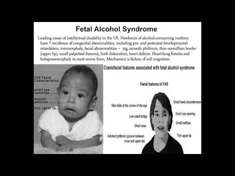 Fetal Alcohol Syndrome [USMLE Highly Tested Topic]