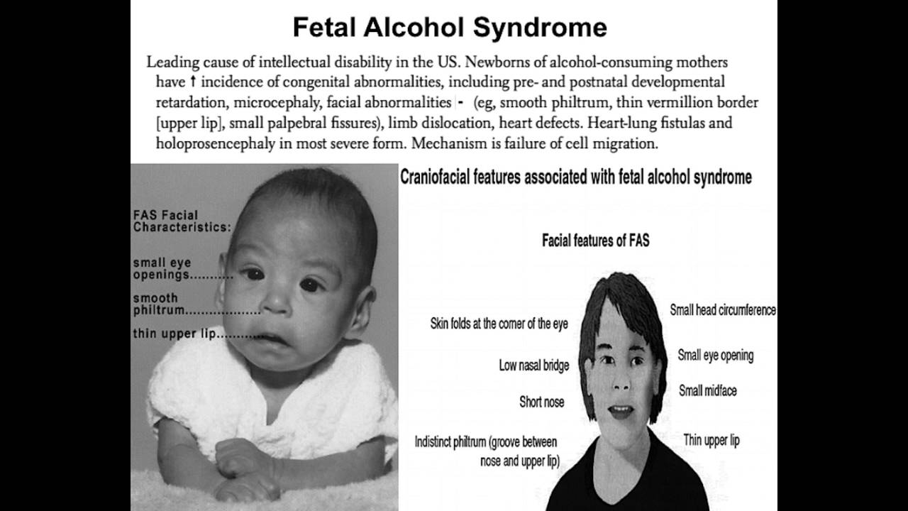 Fetal Alcohol Syndrome [USMLE Highly Tested Topic]