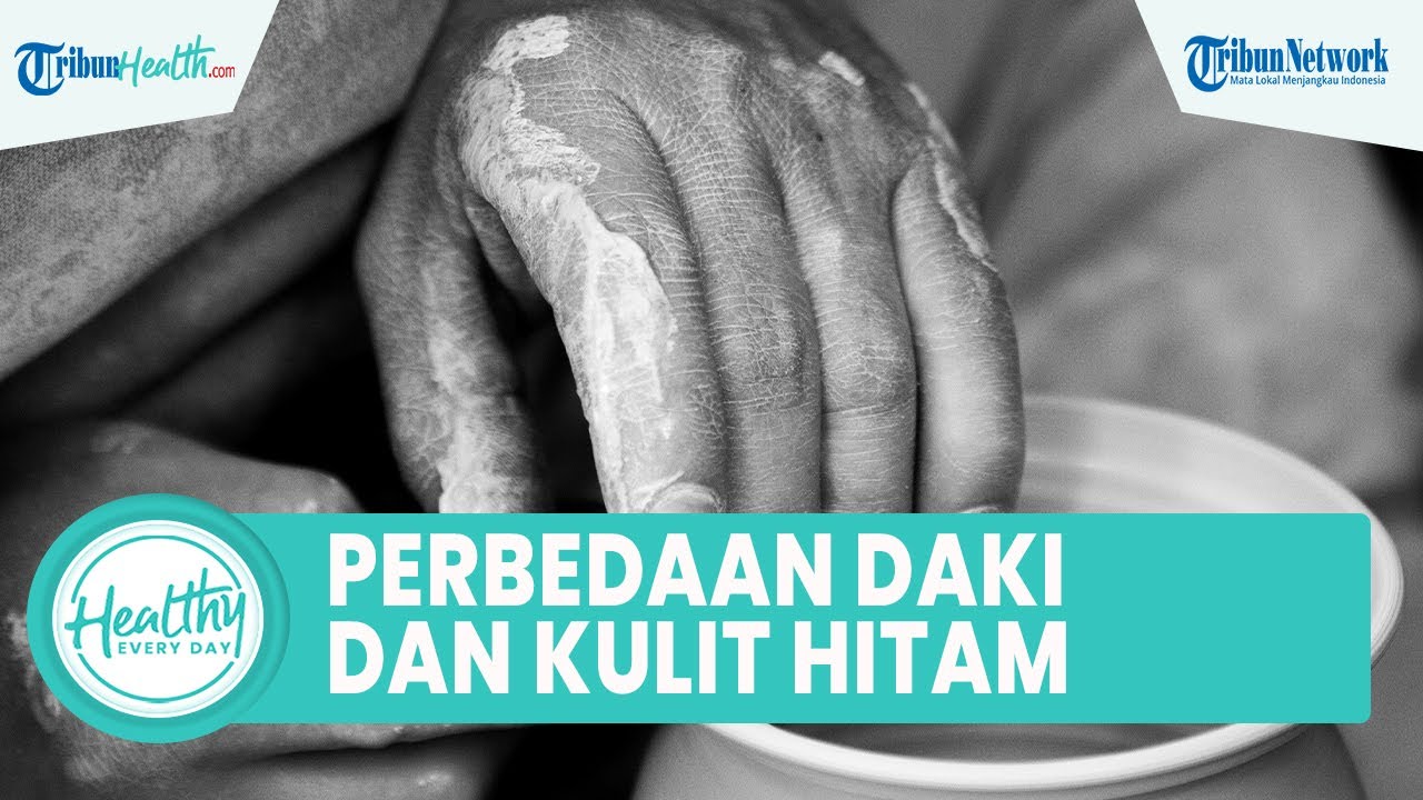 Kenali Perbedaan Daki dengan Kulit Hitam, Begini Penyebab Kotoran Sel ...