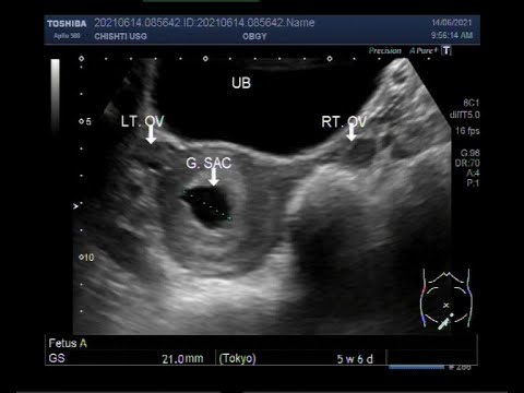 A Blighted ovum also called as Anembryonic pregnancy.