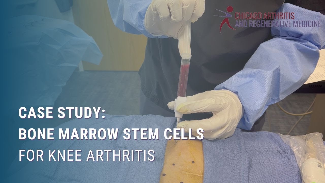 Case Study: Bone Marrow Stem Cells for Knee Arthritis | Chicago Arthritis - Chicago Arthritis ...